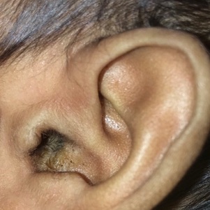 hi my baby is 150 days old,I can see yellow colour discharge at the ear ...