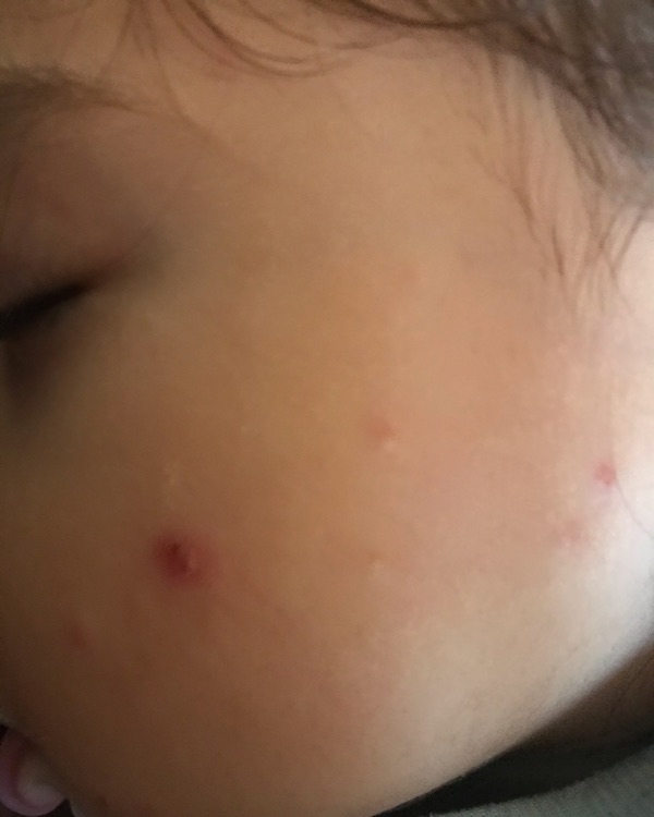 #AskTheExpert Hi Sir, My 6 months old daughter is getting pimples on ...