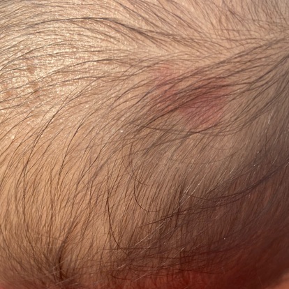 Noted red spots on back of my baby's head.. I m worried.. Is it normal ...