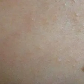 Hello, My baby is 4 months old and he has a pimple kind of rash on his ...